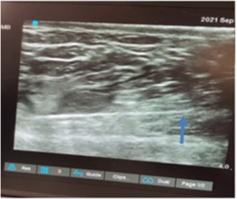 View of hypoechogenic ﬂuid in deep layer of fat after injection with ...